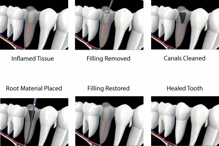Endodontic Retreatment - Dental Specialty Group